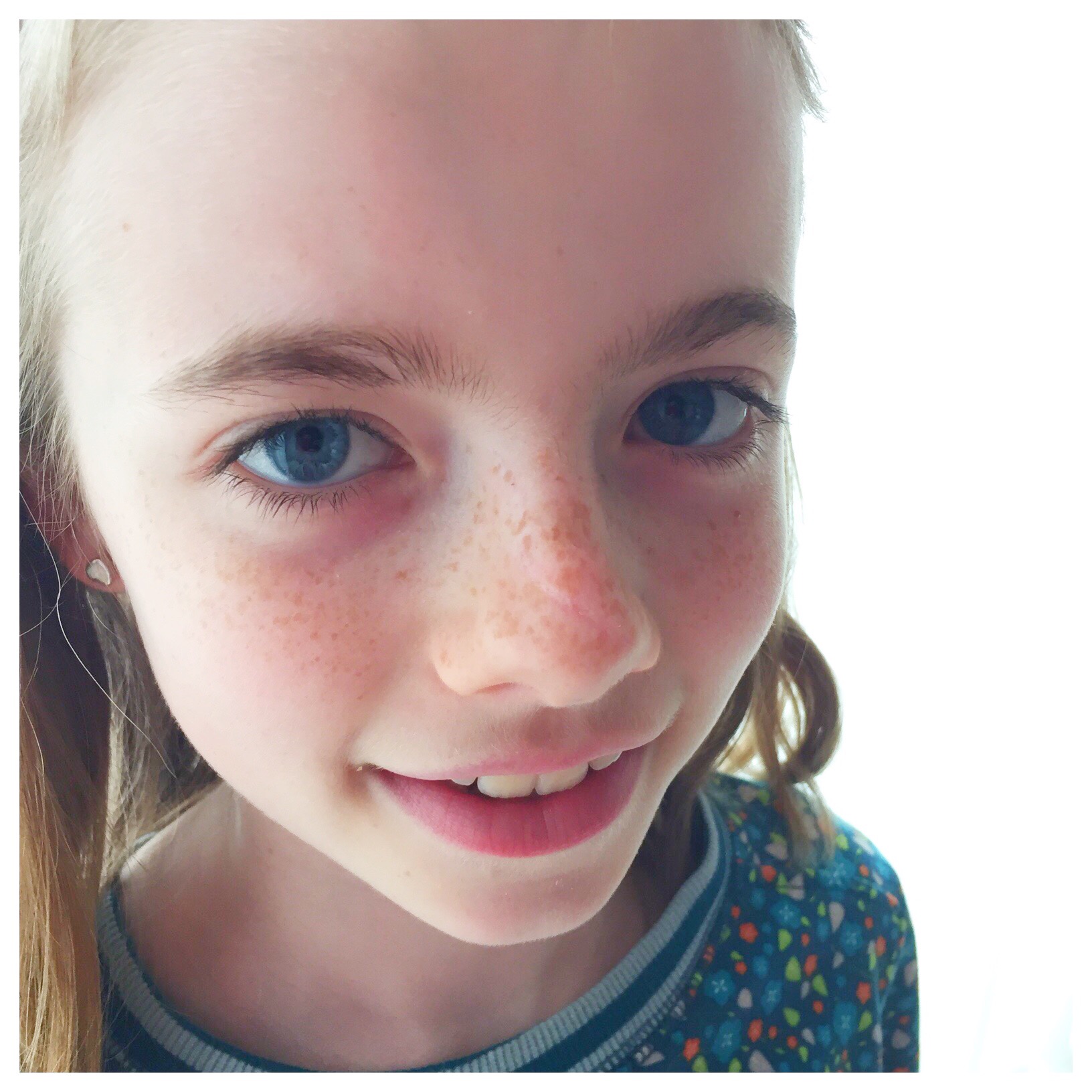 Litteken Gezicht Genezen Littekentherapie Skintastics Cosmetische