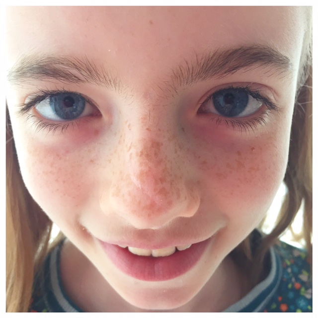 Littekens in het gezicht behandelen - Hip & Hot - blogazine